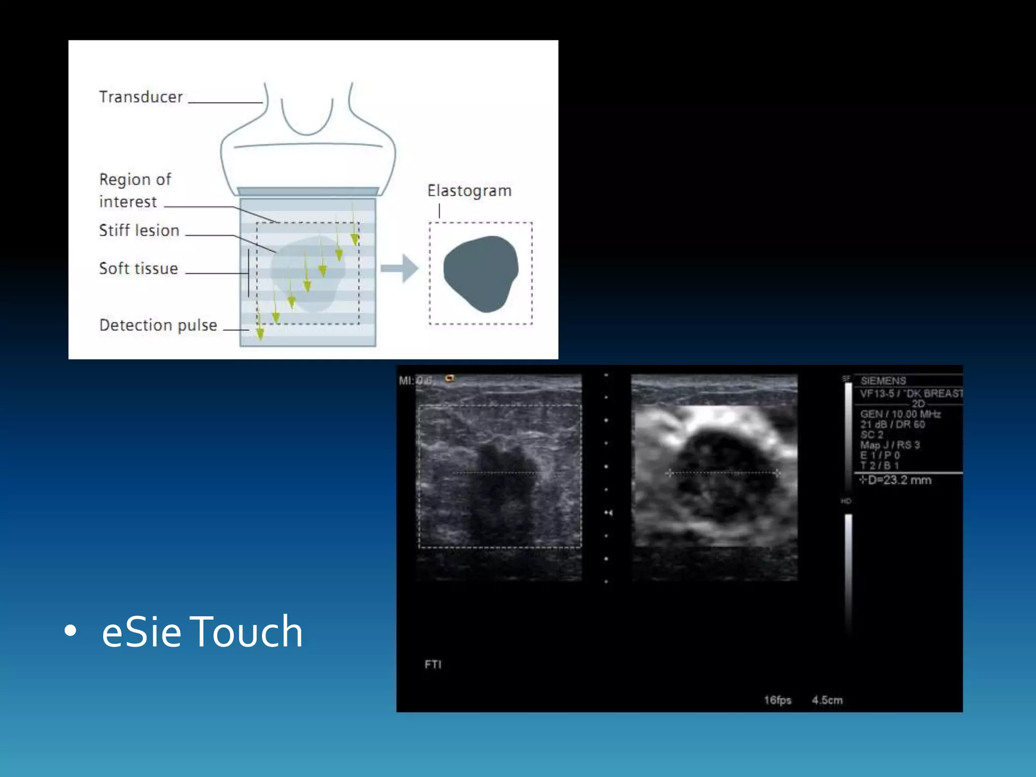 Ultrasound Elastography | PPTX