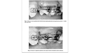 Elastomeric and coil springs | PPTX