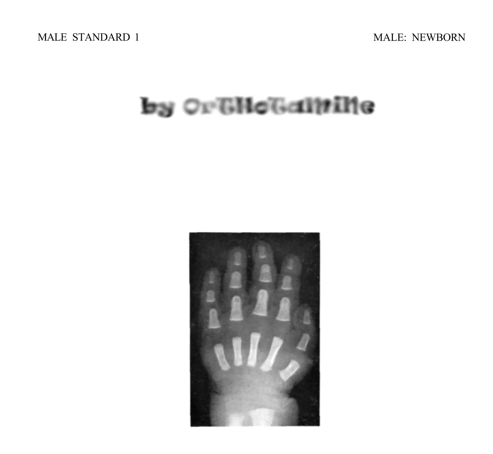 bone age atlasbone age atlas bone age atlas | PDF