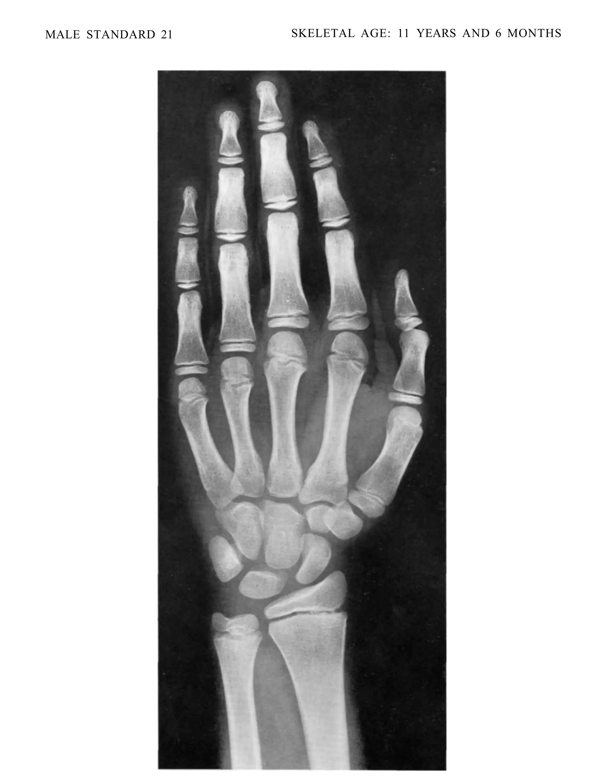 bone age atlasbone age atlas bone age atlas | PDF
