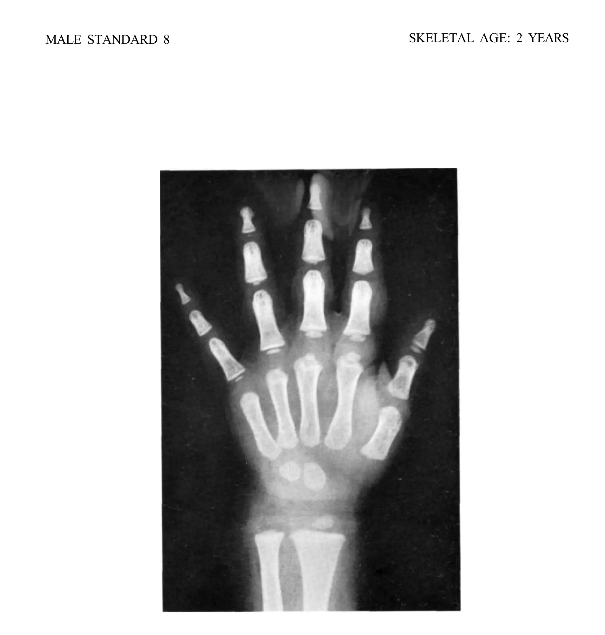 bone age atlasbone age atlas bone age atlas | PDF