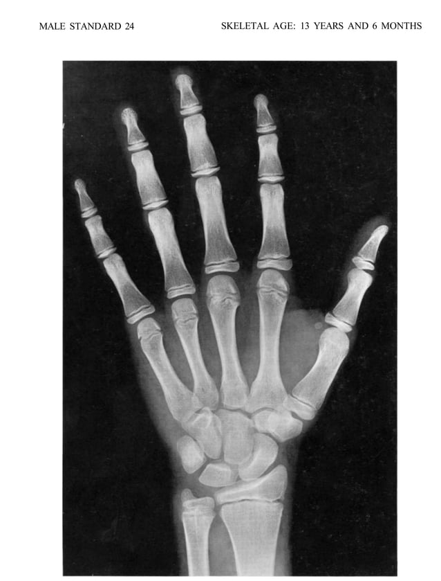 bone age atlasbone age atlas bone age atlas | PDF