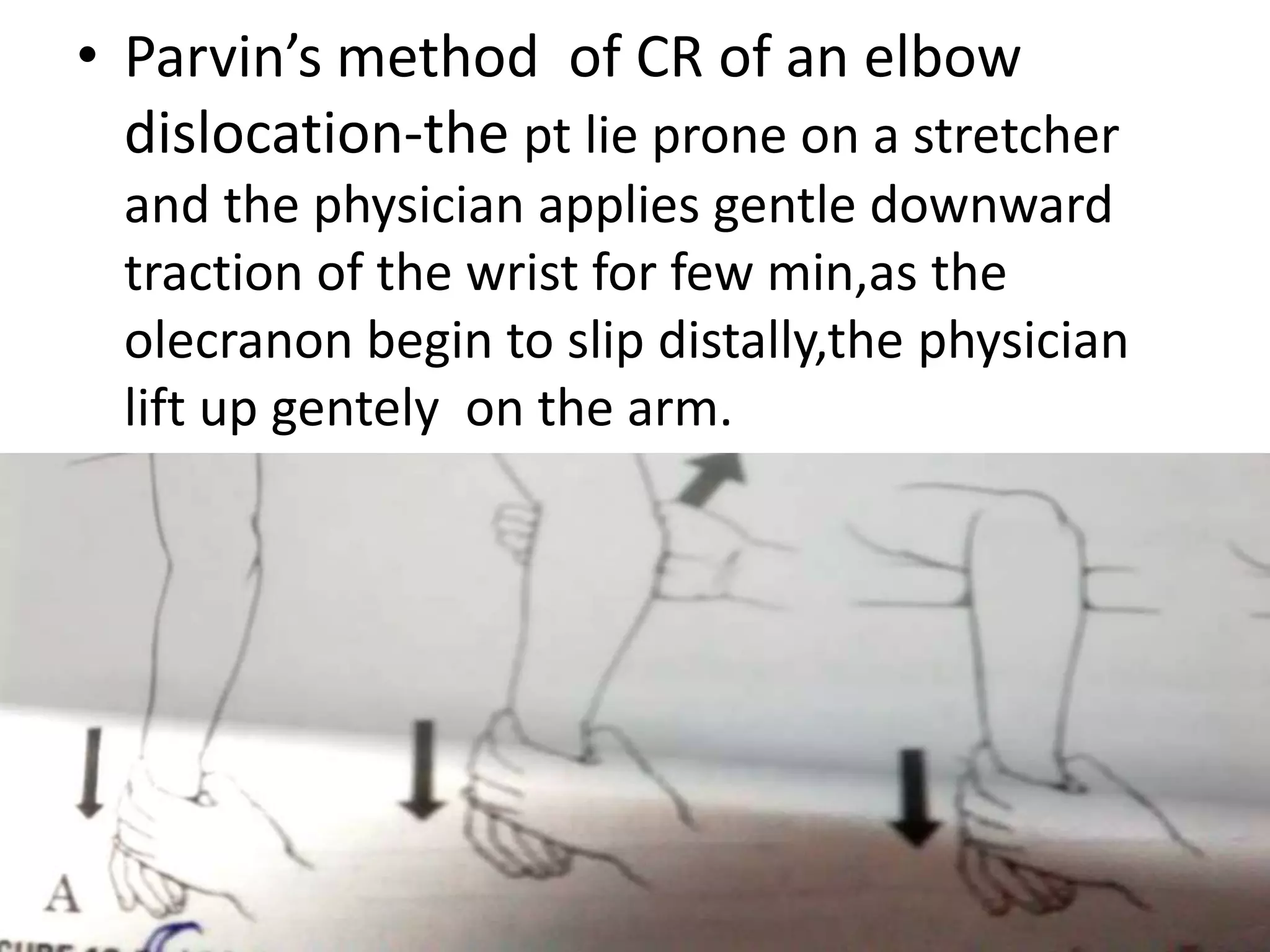 dislocations & fractures of Elbow in adults | PPTX