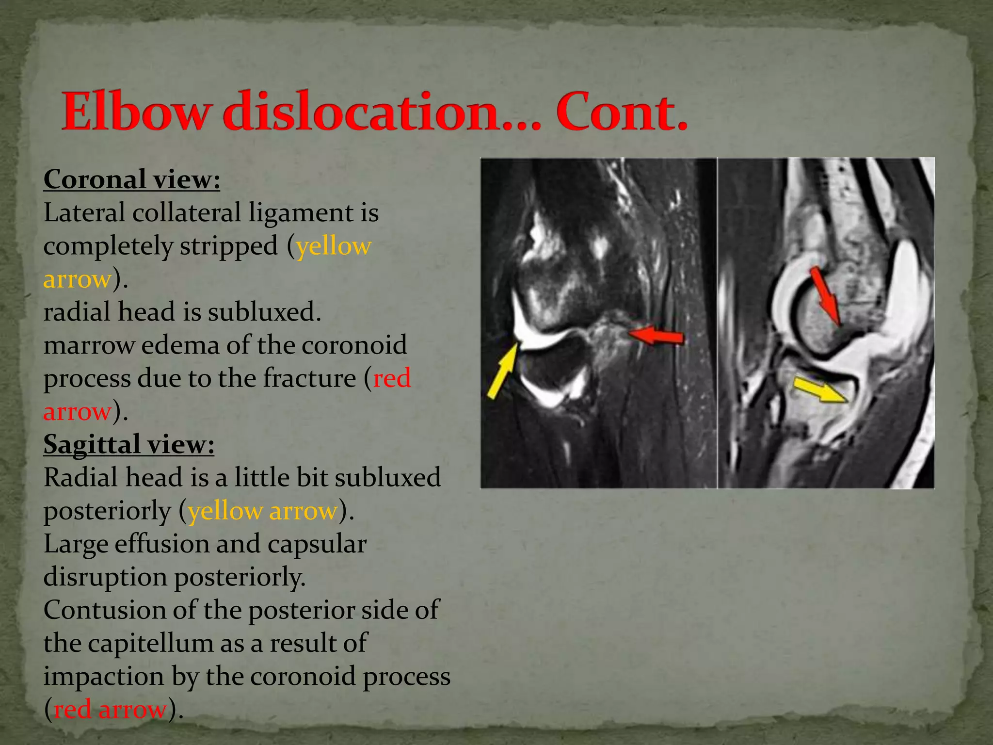 Elbow MRI | PPTX