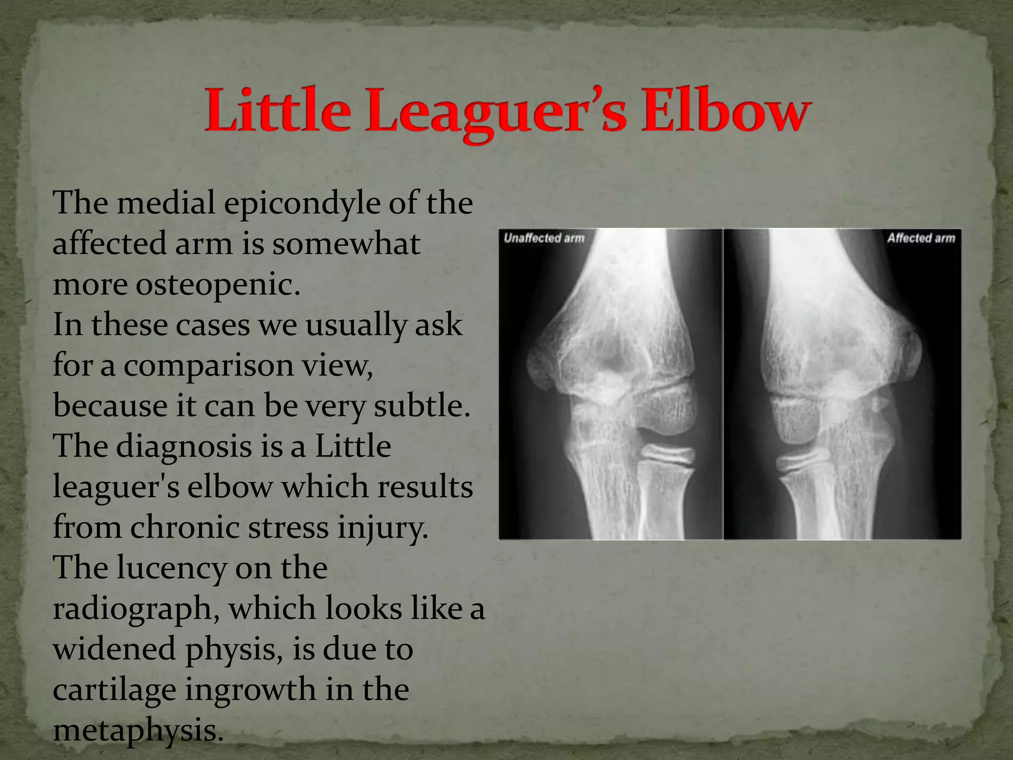 Elbow MRI | PPTX