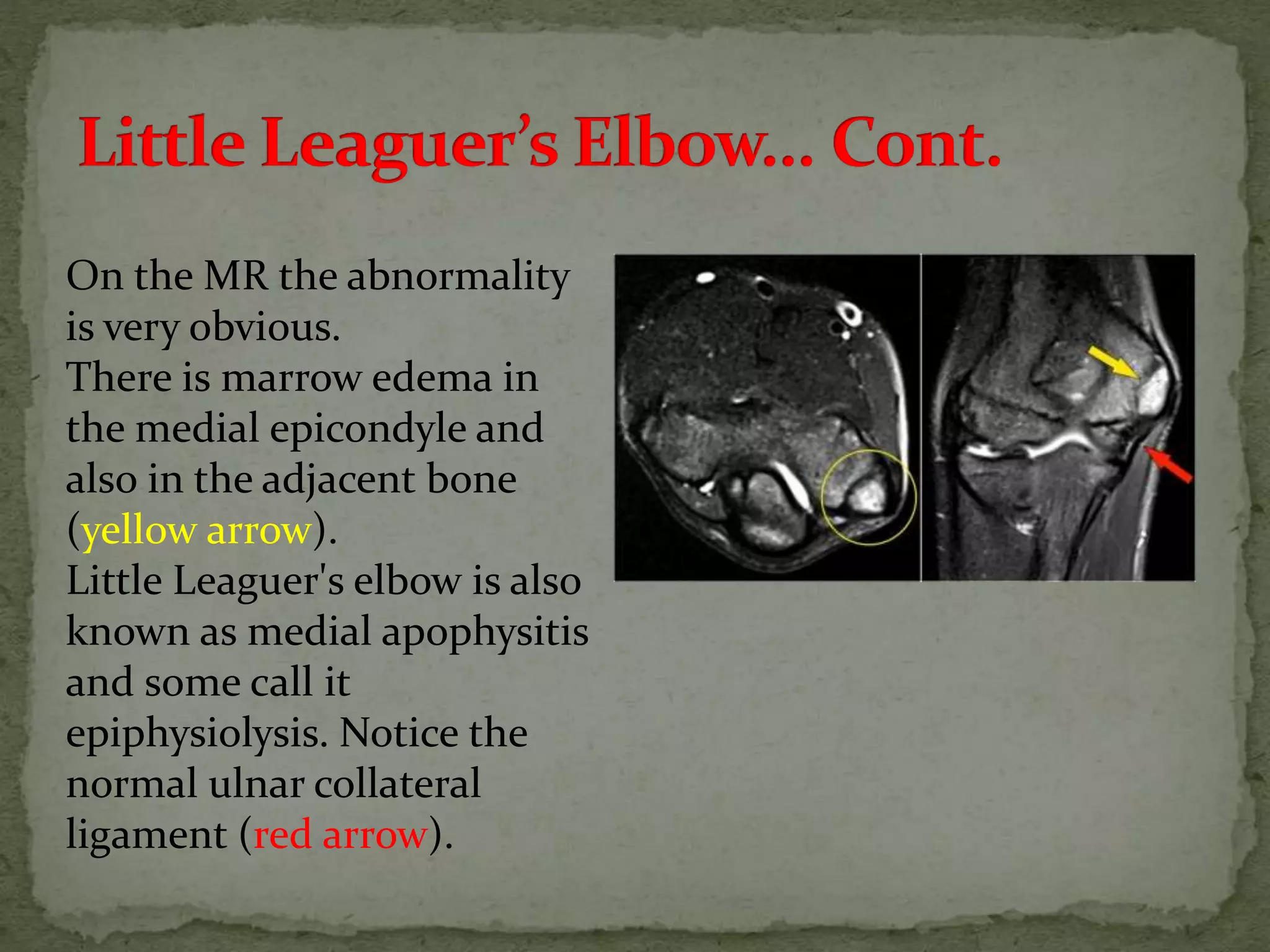 Elbow MRI | PPTX
