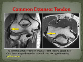 Elbow MRI | PPTX