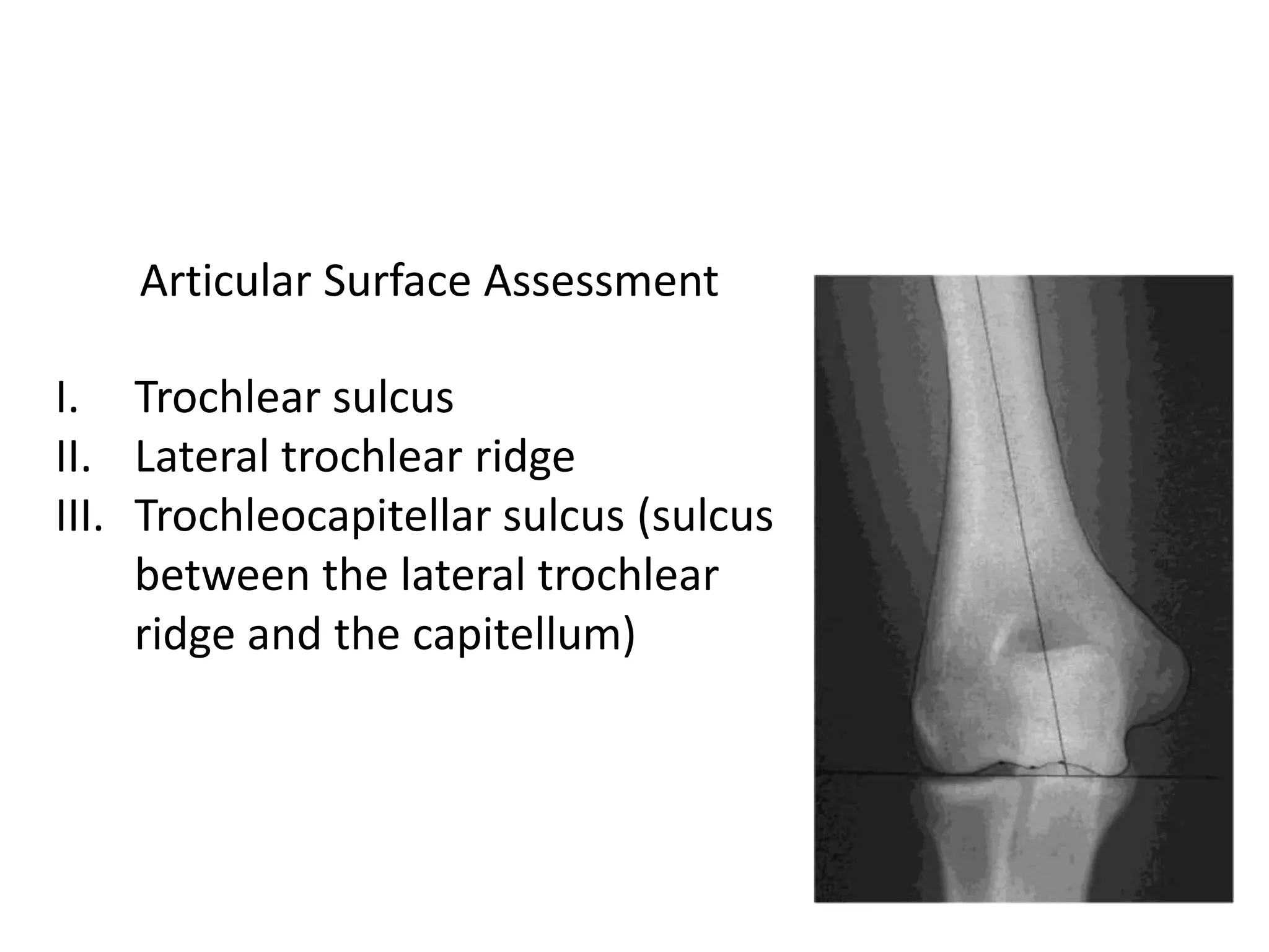 Elbow FRACTURE | PPTX