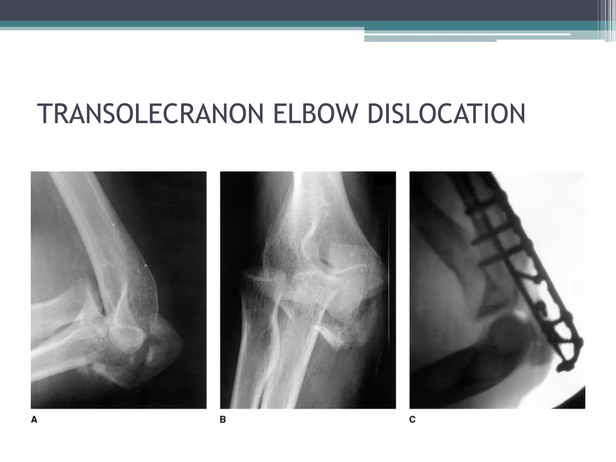 Elbow instability | PPTX