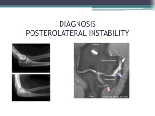 Elbow instability | PPTX