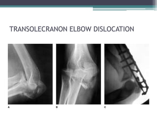Elbow instability | PPTX