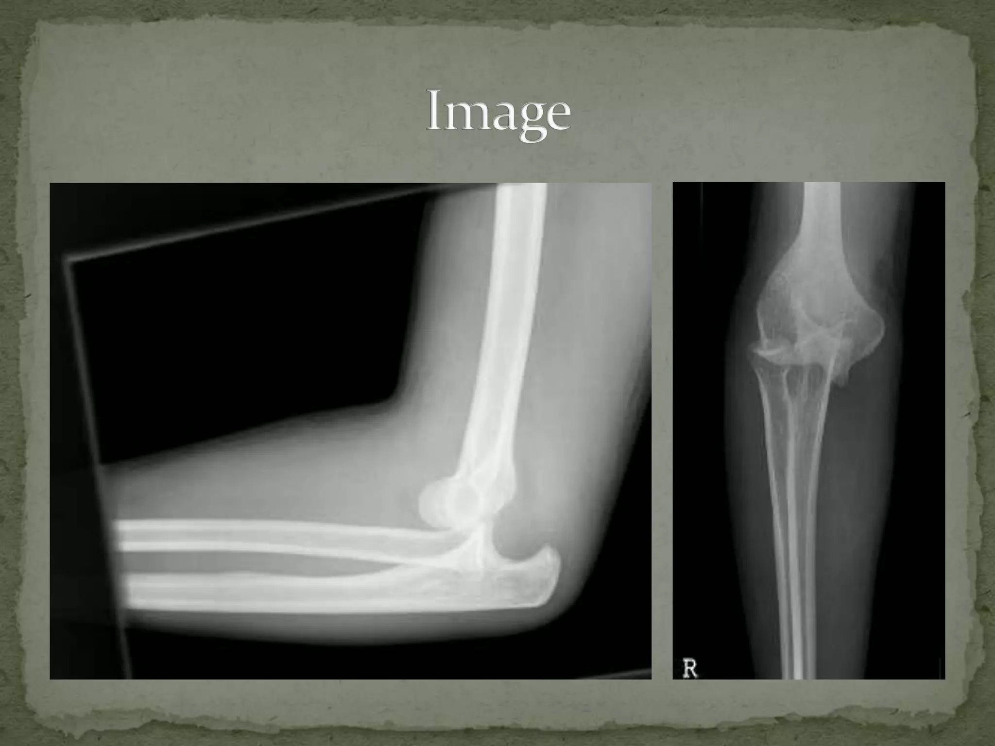 Posterior Elbow Dislocation | PPTX