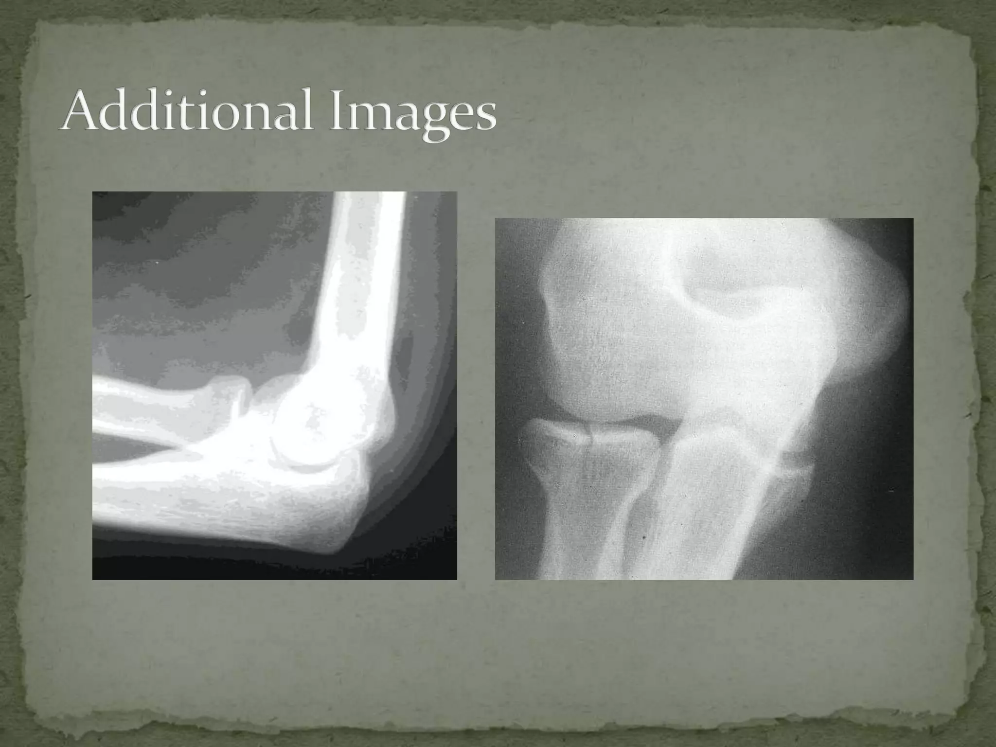 Radial Head Fracture | PPTX