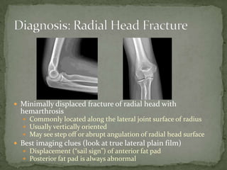 Radial Head Fracture | PPTX