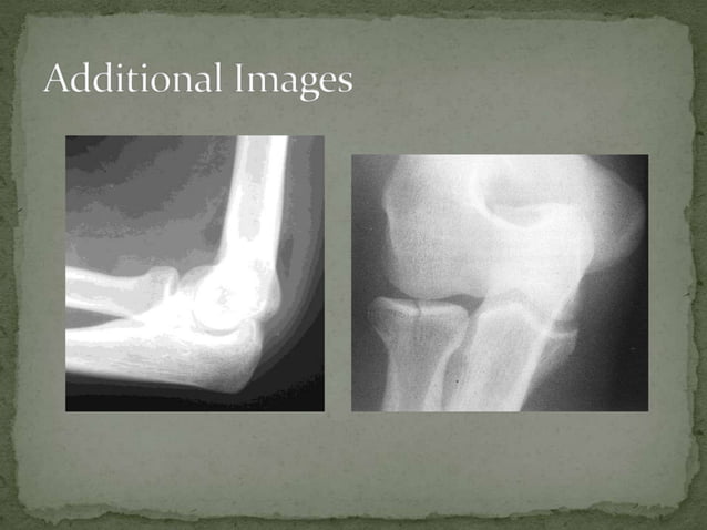 Radial Head Fracture Ppt