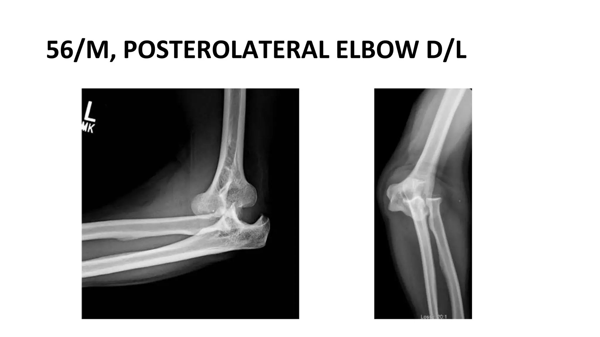 ELBOW INJURY AND TERRIBLE TRAID.pptx