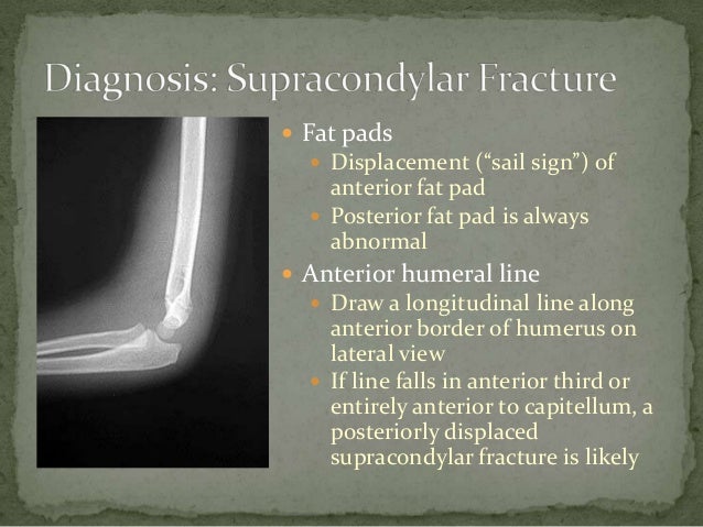 Supracondylar Fracture