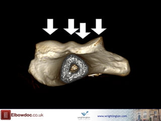 Elbow anatomy and biomechanics | PDF