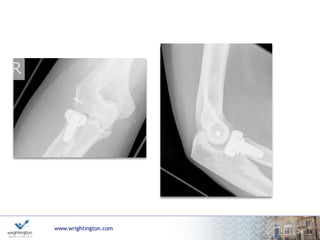 Elbow anatomy and biomechanics | PDF