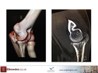 Elbow anatomy and biomechanics | PDF