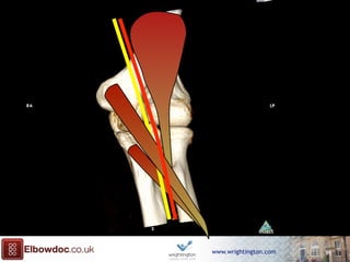 Elbow anatomy and biomechanics | PDF