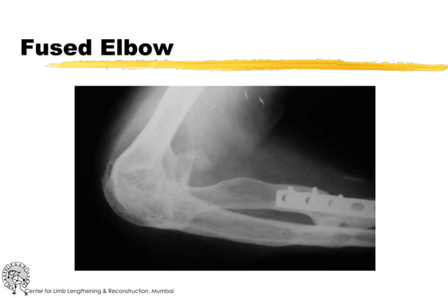 Elbow arthrolysis bad cartilage | PPT