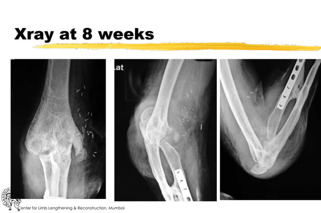 Elbow arthrolysis bad cartilage | PPT