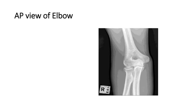 elbow biomechanics and Pathomechanics.pptx | Death, Injury, or Military ...