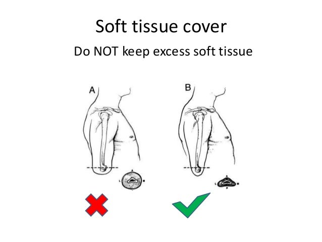 Elbow disarticulation