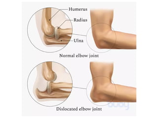 Elbow Dislocation - Anatomy WPS Office.pptx | Death, Injury, or Military Conflict | Sensitive Topics