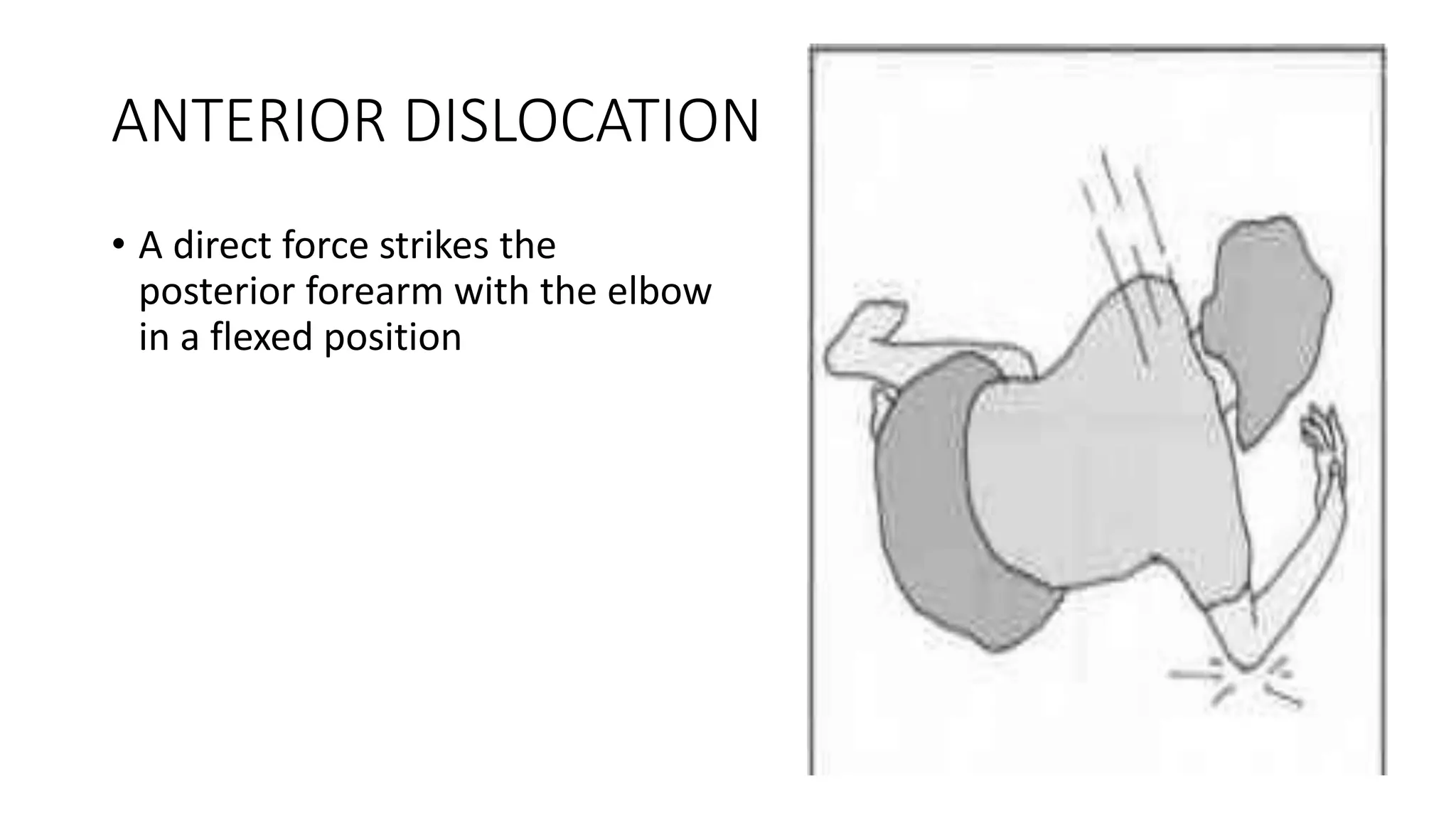 Elbow dislocation | PPTX