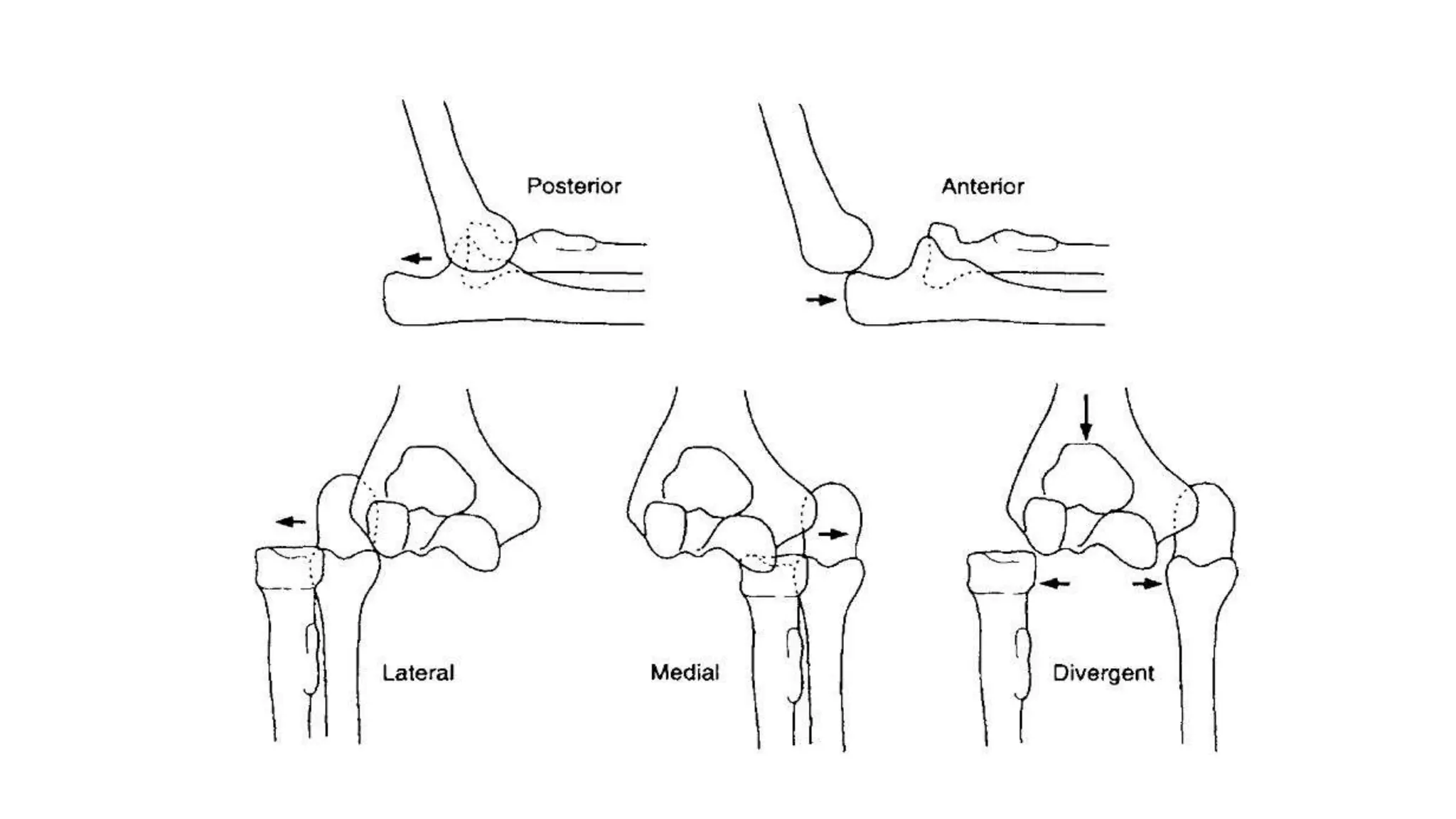 Elbow dislocation | PPTX