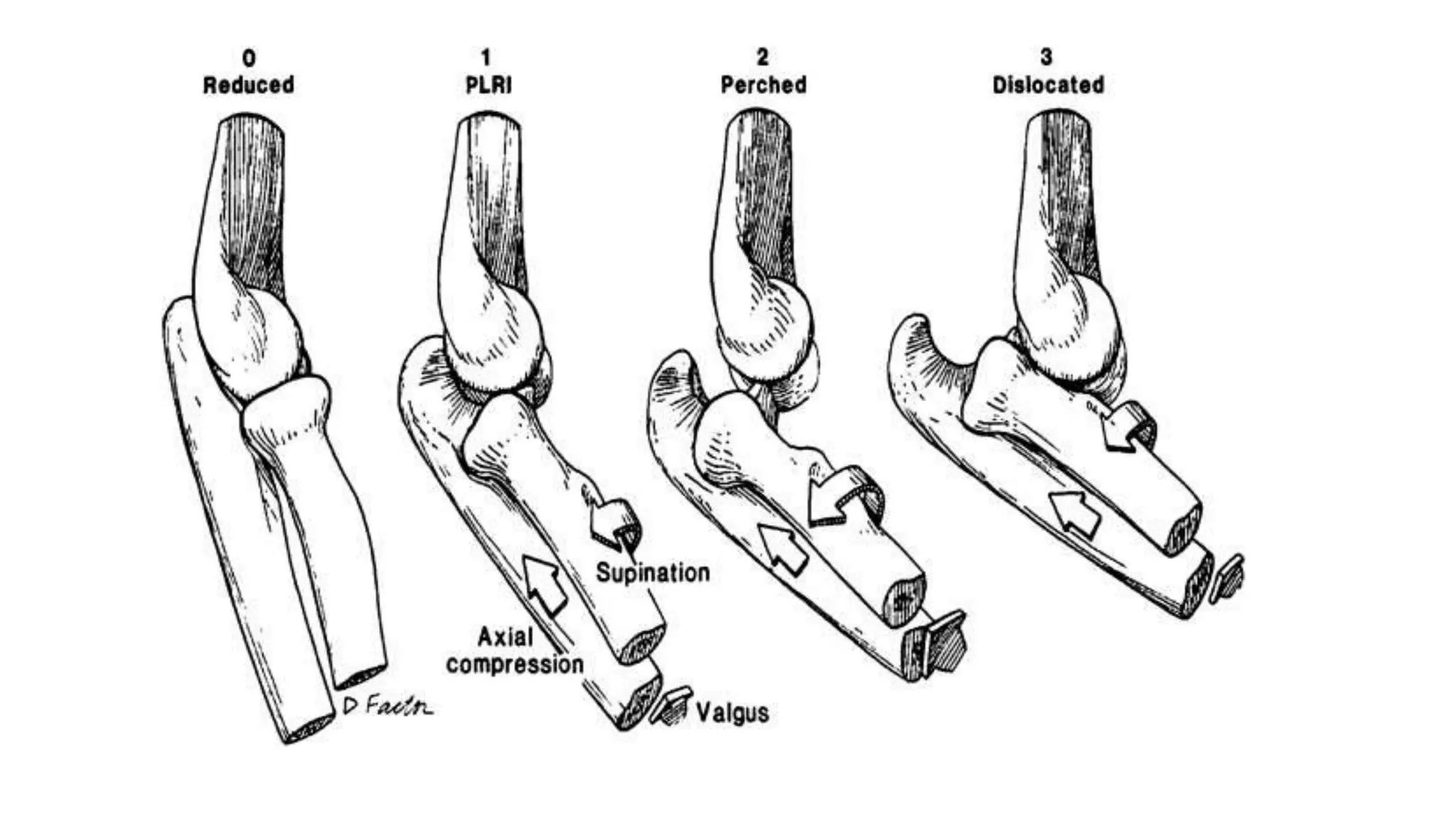 Elbow dislocation | PPTX