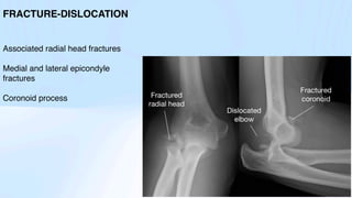Elbow dislocation treatment options and recovery time | PPT