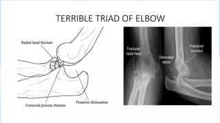 Elbow dislocation treatment options and recovery time | PPT