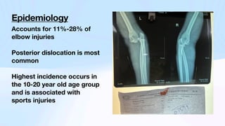 Elbow dislocation treatment options and recovery time | PDF
