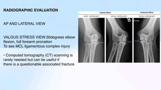 Elbow dislocation treatment options and recovery time | PPT