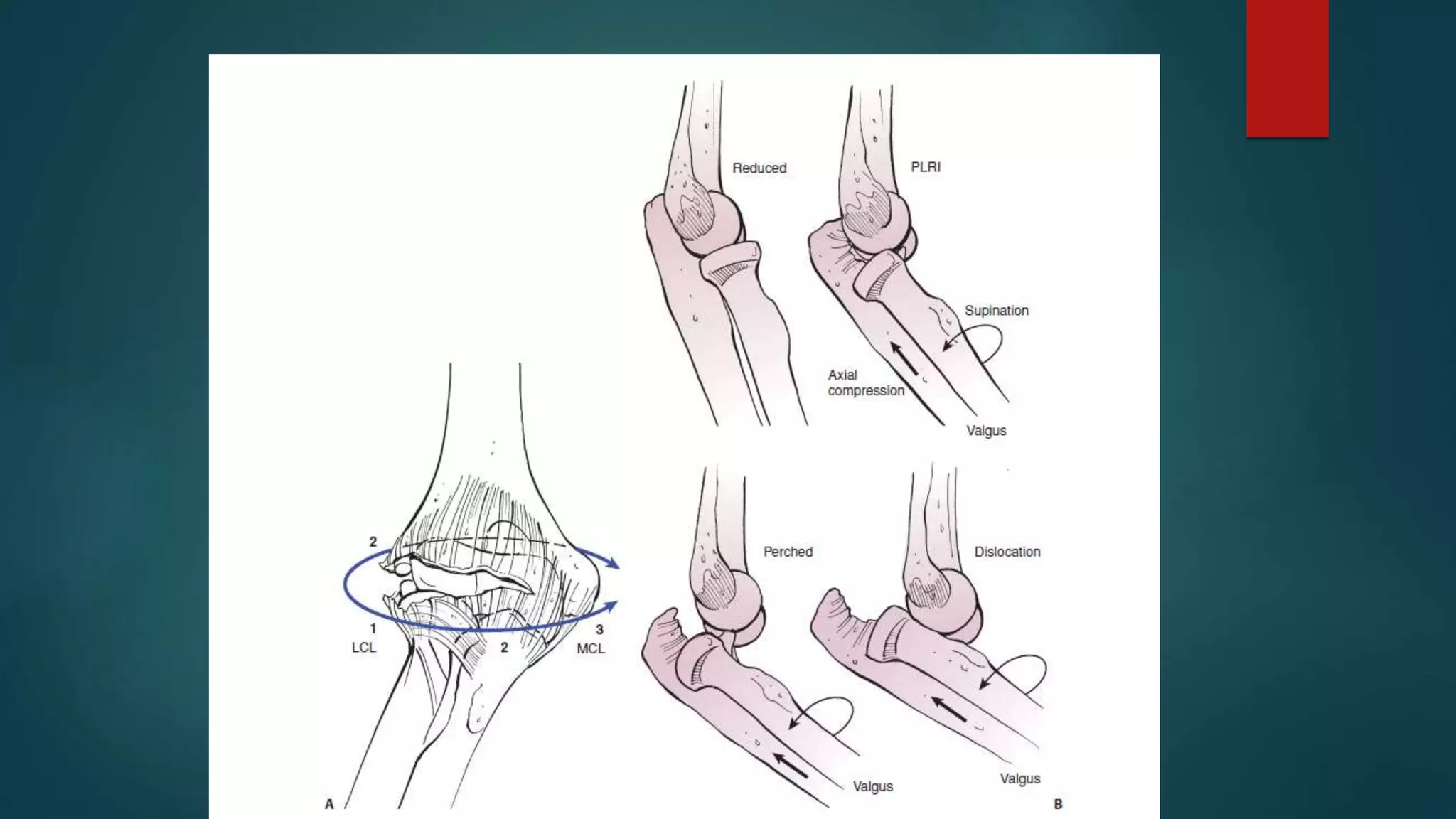 Elbow dislocations | PPTX