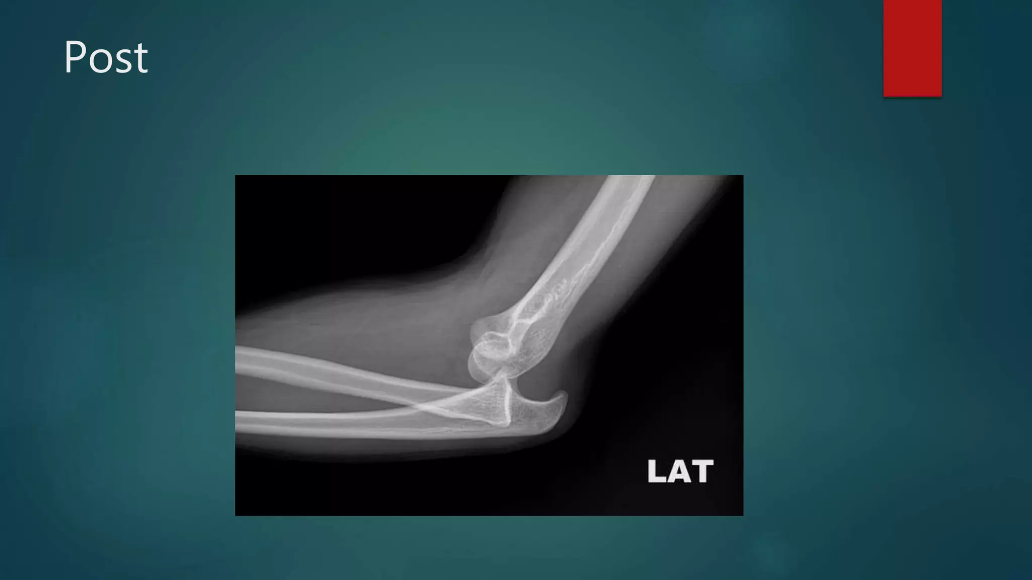 Elbow dislocations | PPTX