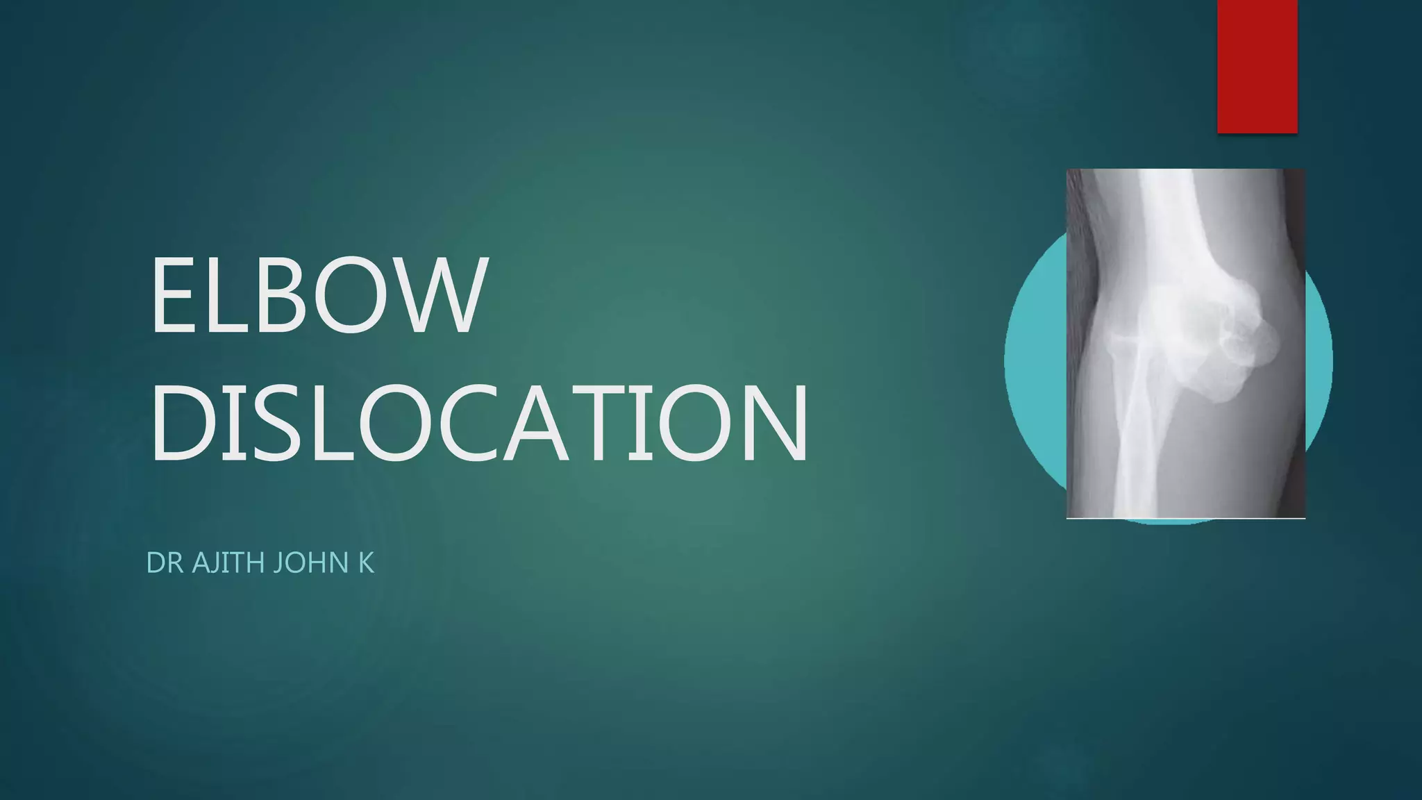 elbowdislocations-180623080147 (1).pptx