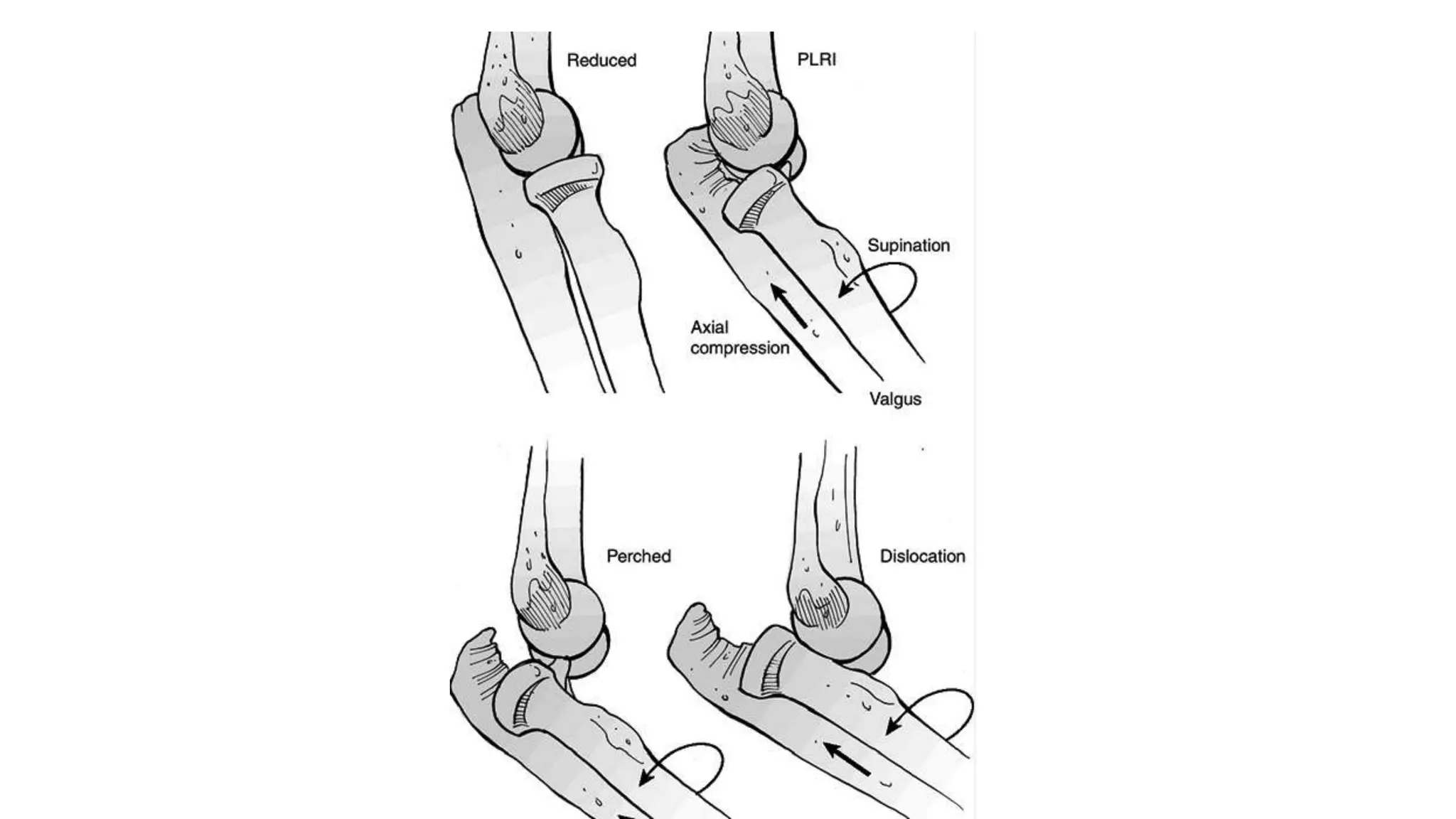 Elbow dislocations | PPTX