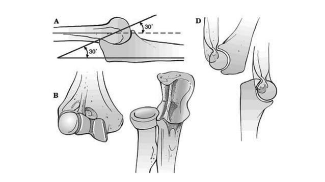 Elbow dislocations | PPTX