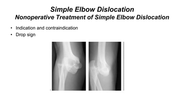 Elbow dislocations and terrible triad | PPTX | First Aid | Injuries