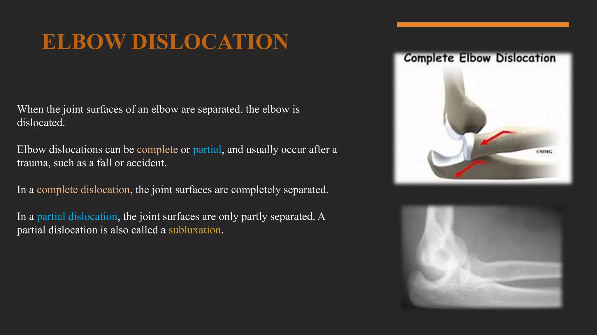 Elbow dislocation and subluxation | PPTX