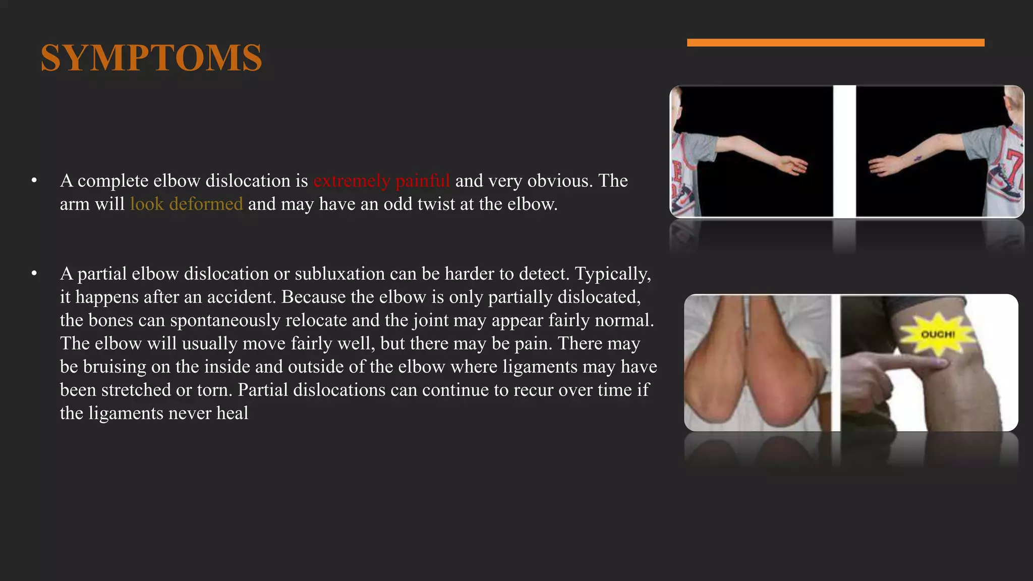 Elbow dislocation and subluxation | PPTX