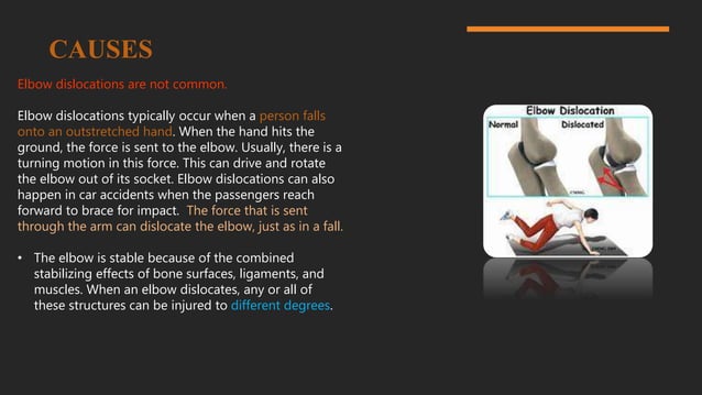 Elbow dislocation and subluxation | PPTX | First Aid | Injuries