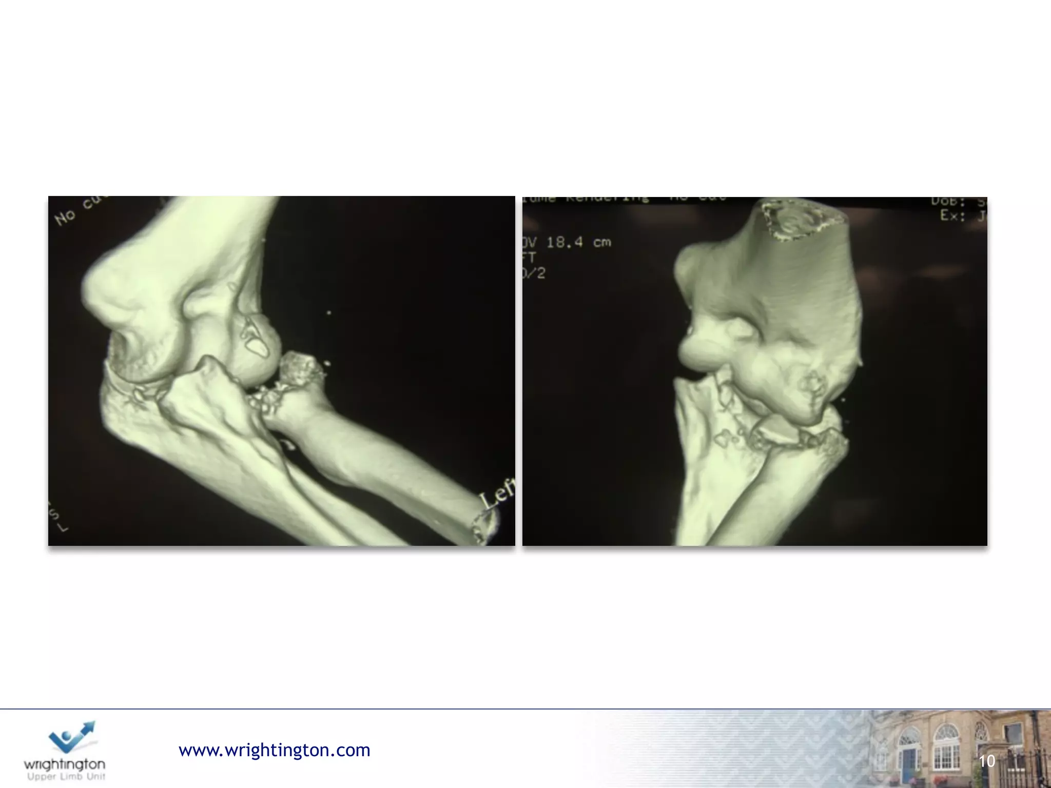 Elbow fracture dislocations adam watts | PDF