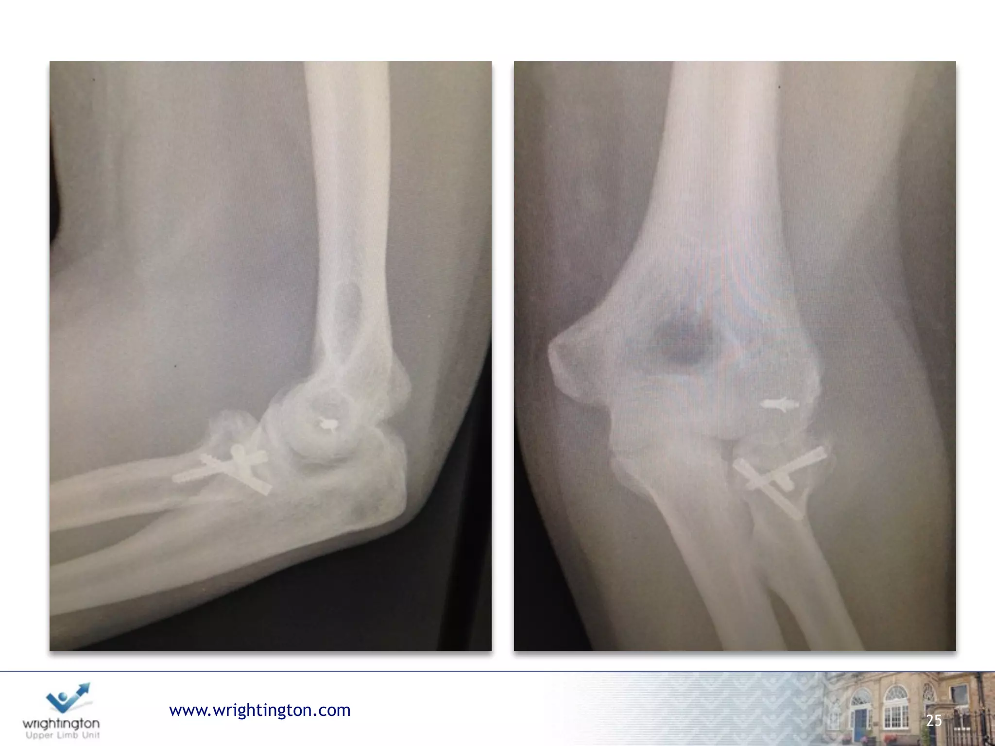Elbow fracture dislocations adam watts | PDF