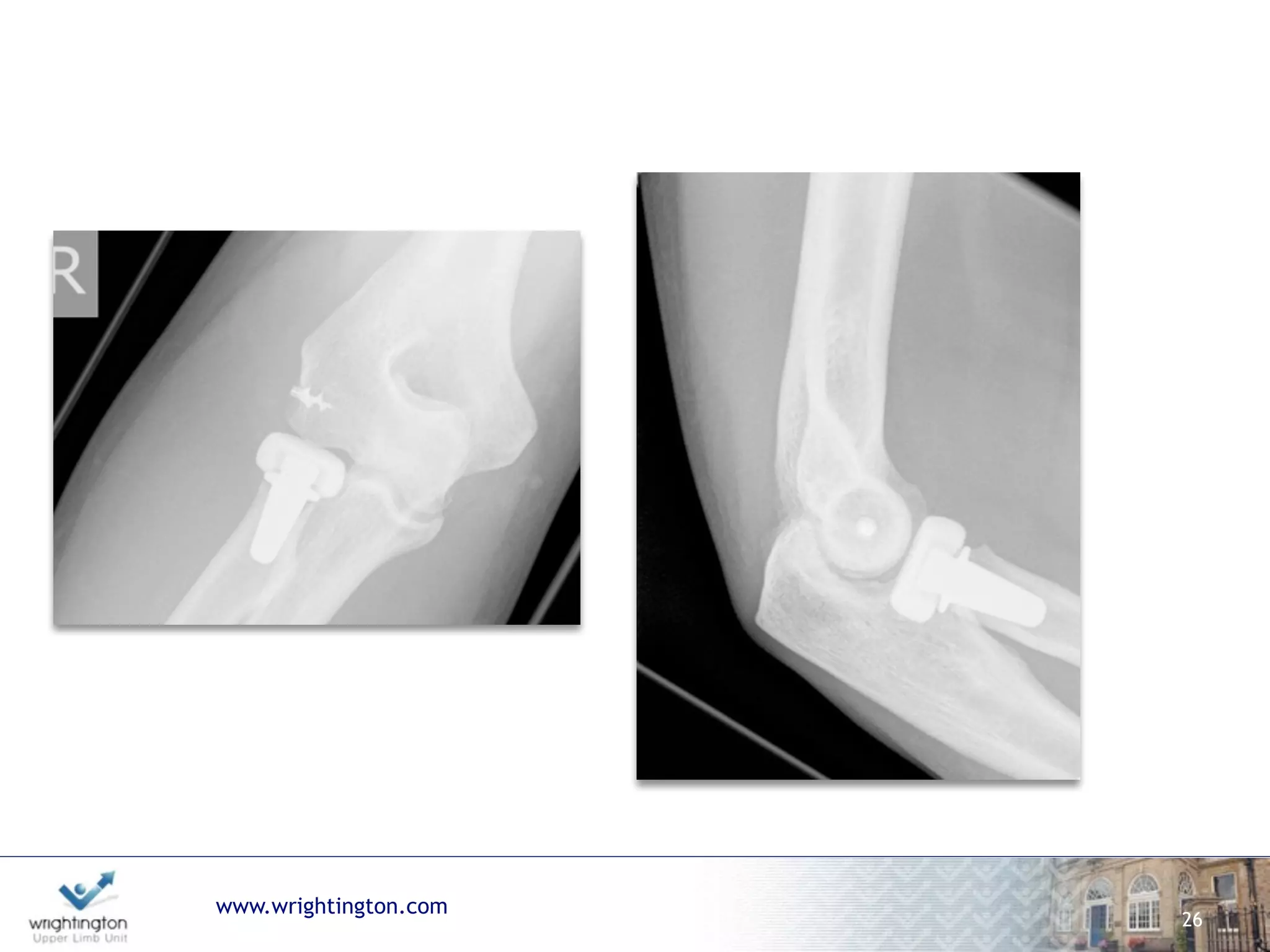Elbow fracture dislocations adam watts | PPT