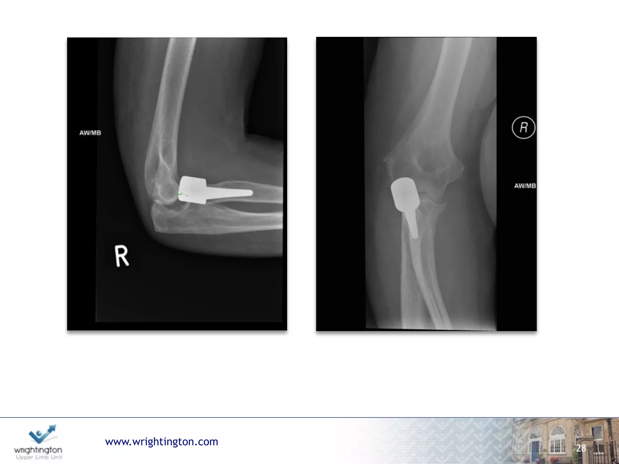 Elbow fracture dislocations adam watts | PDF